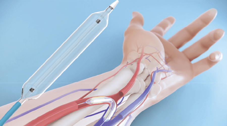 A.V. Shunt Stenosis Dilatation Balloon Catheter | Bioteque Corporation (Headquarter)